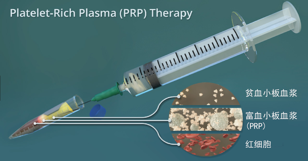 三分钟教你认识PRP-春雨医生