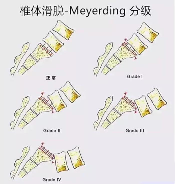 科普：腰椎滑脱的Meyerding分级-春雨医生