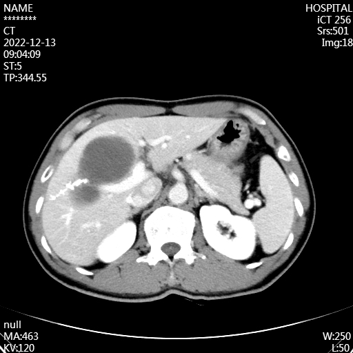 介入联合靶向+免疫治疗，三管齐下，给晚期肝癌带来根治性希望-春雨医生